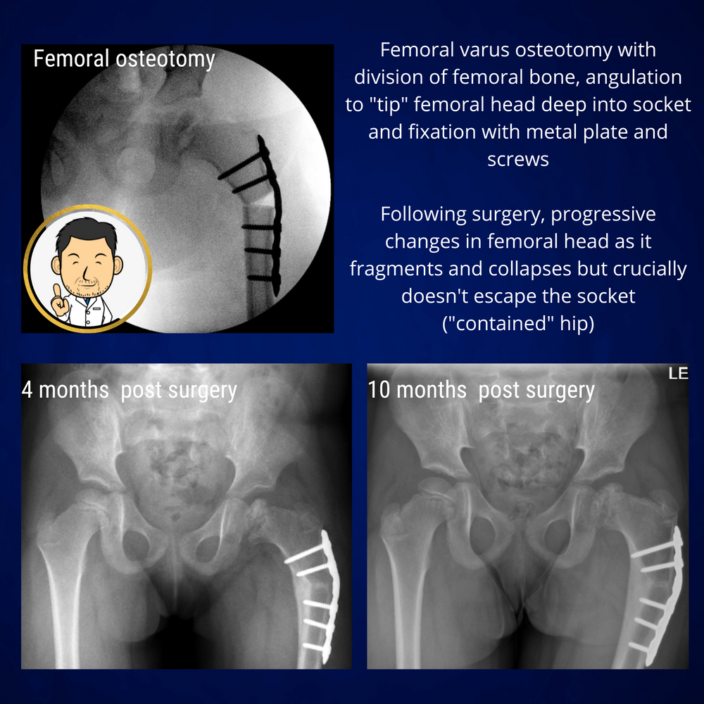 Legg Calve Perthes Disease