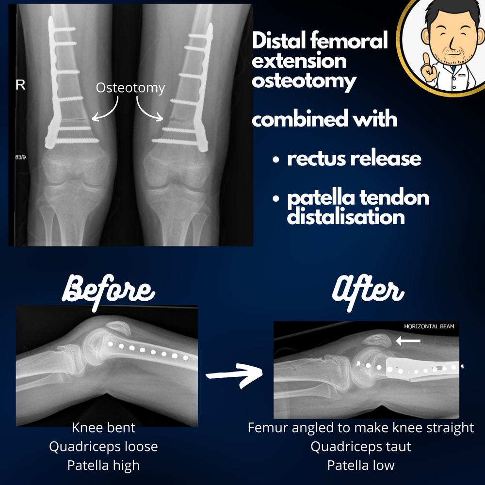 Gait optimisation surgery in Cerebral Palsy