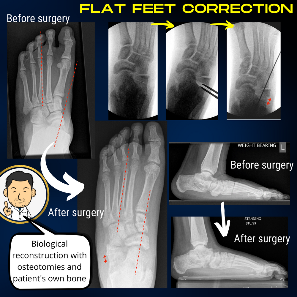 Treatment for Flat feet