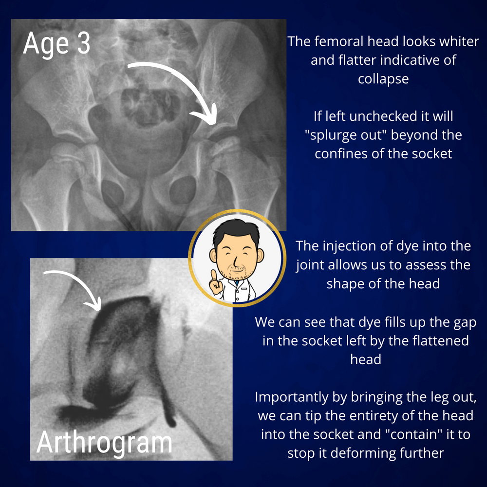 Legg Calve Perthes Disease
