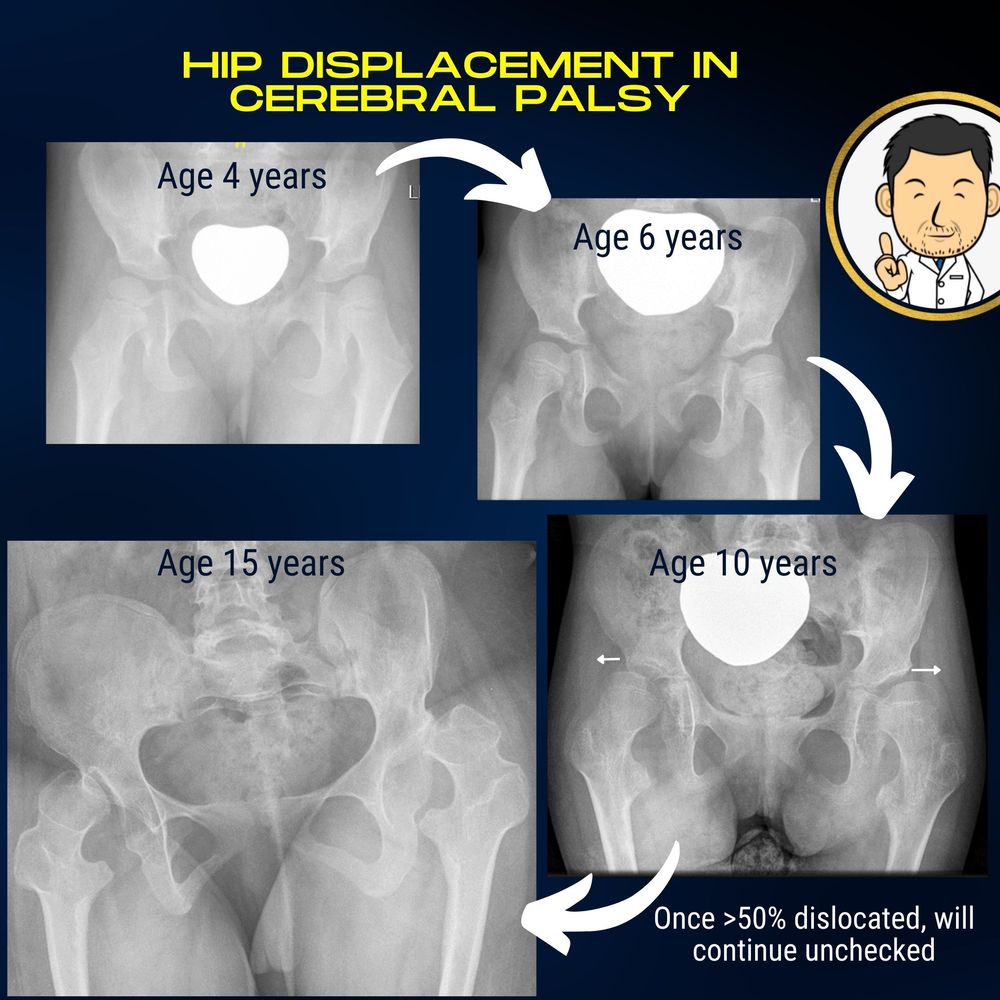 Cerebral palsy - Hip reconstruction