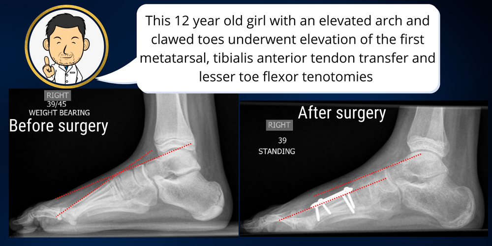 High arched (cavus) feet