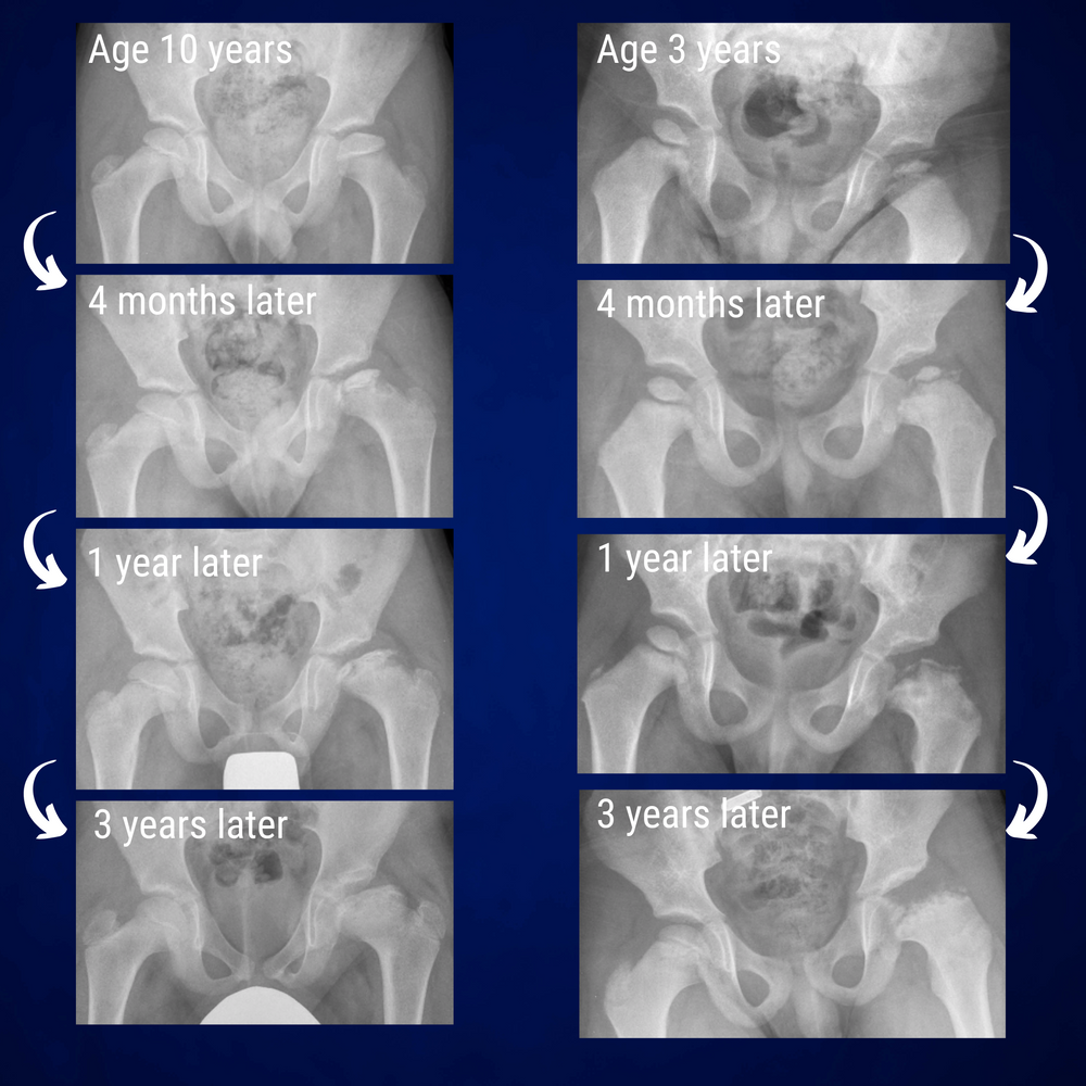 Legg Calve Perthes Disease