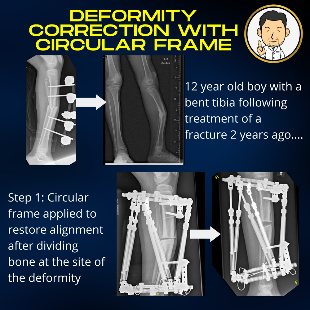 Circular Frame Treatment
