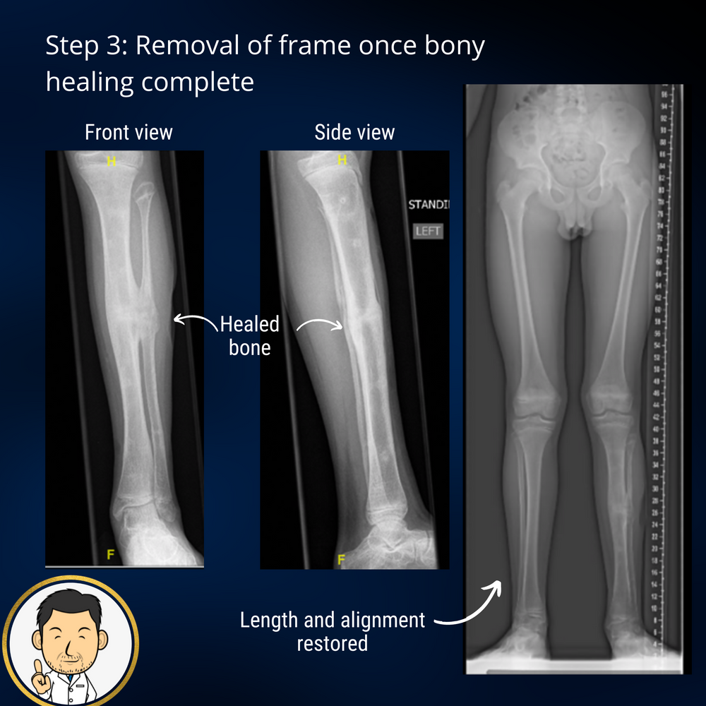 Circular Frame Treatment