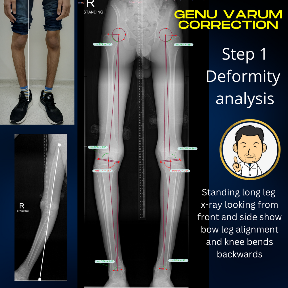 Deformity correction using internal fixation