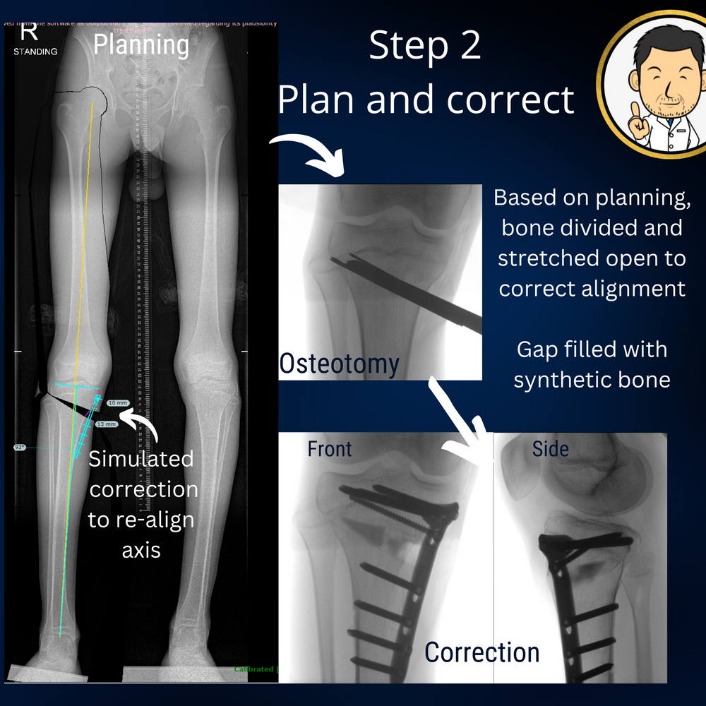 Deformity correction using internal fixation