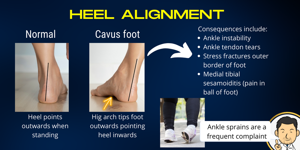 High arched (cavus) feet