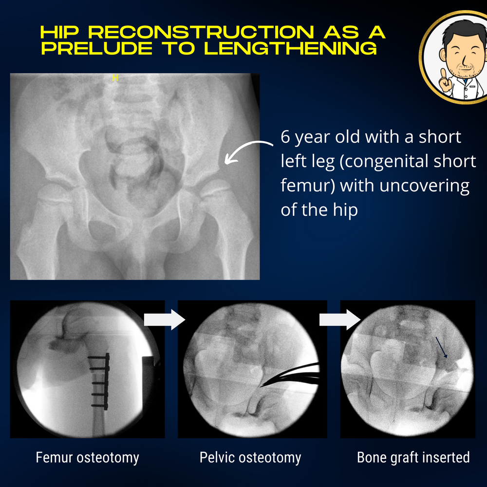 Deformity correction using internal fixation
