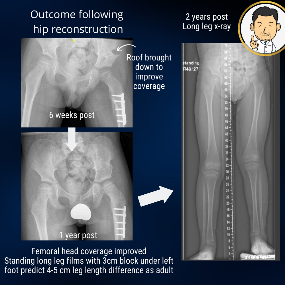 Deformity correction using internal fixation