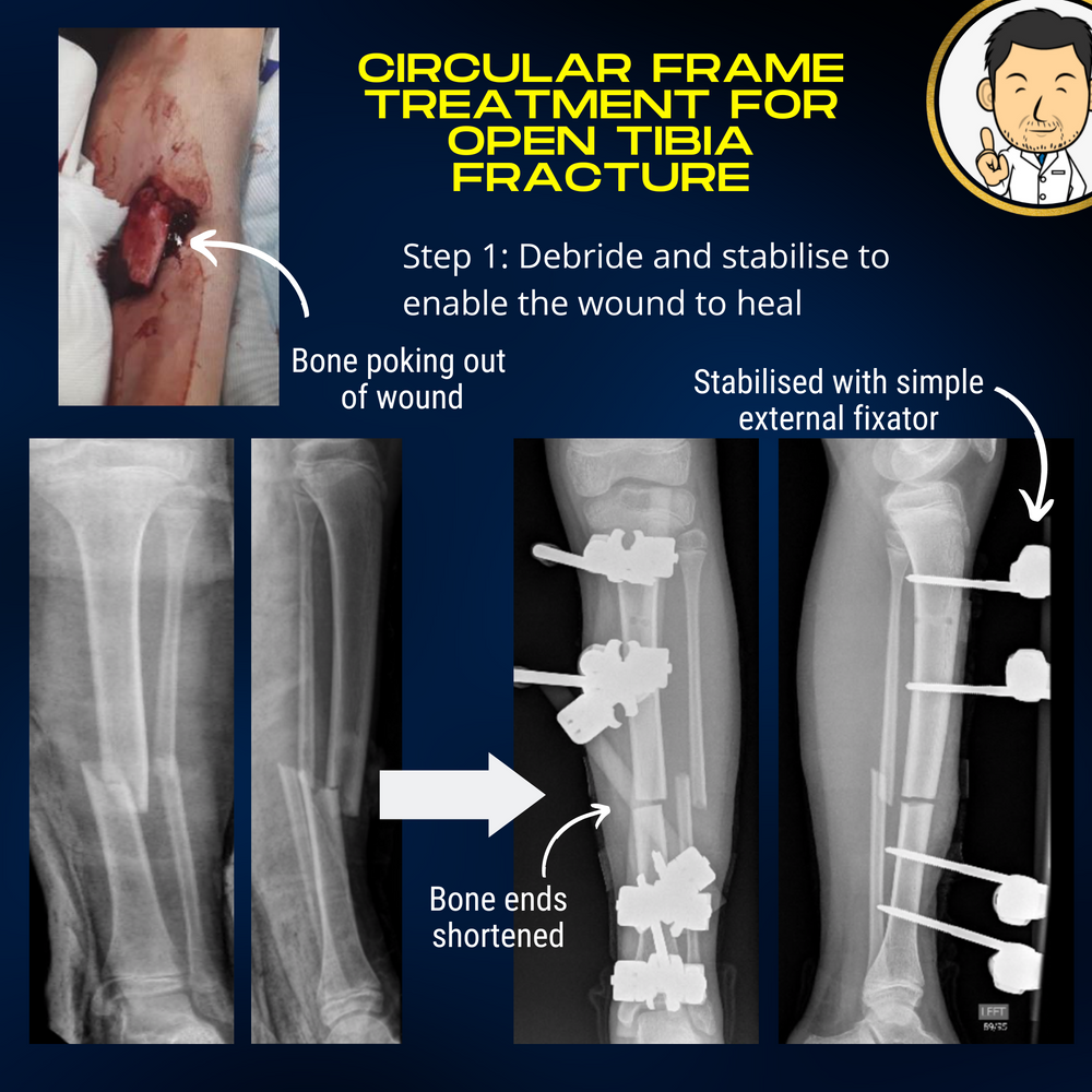 Circular Frame Treatment