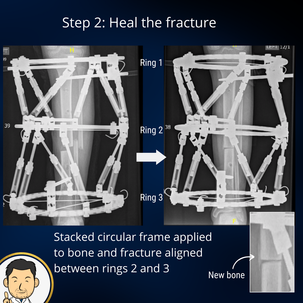 Circular Frame Treatment