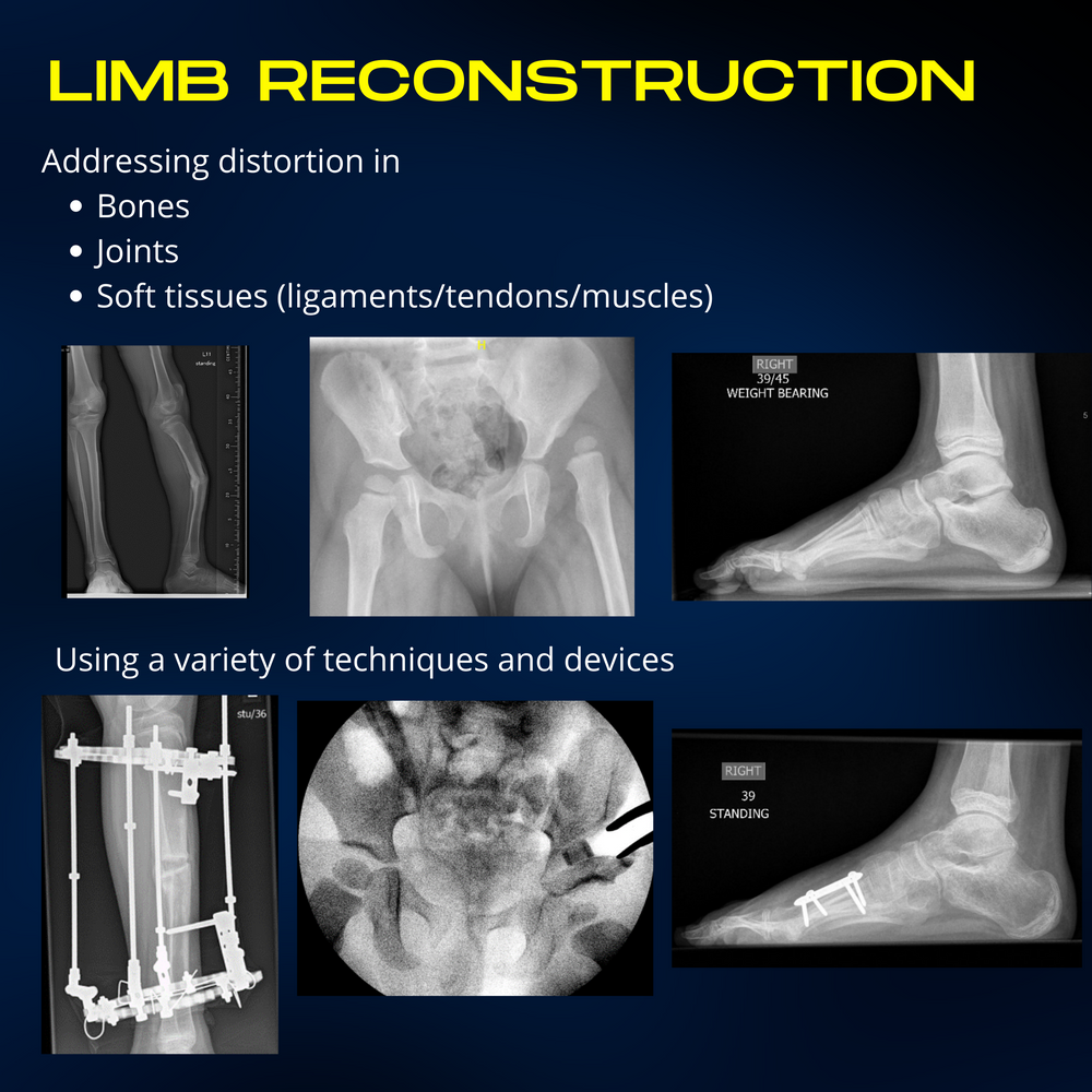 Conditions I Treat Limb Reconstruction