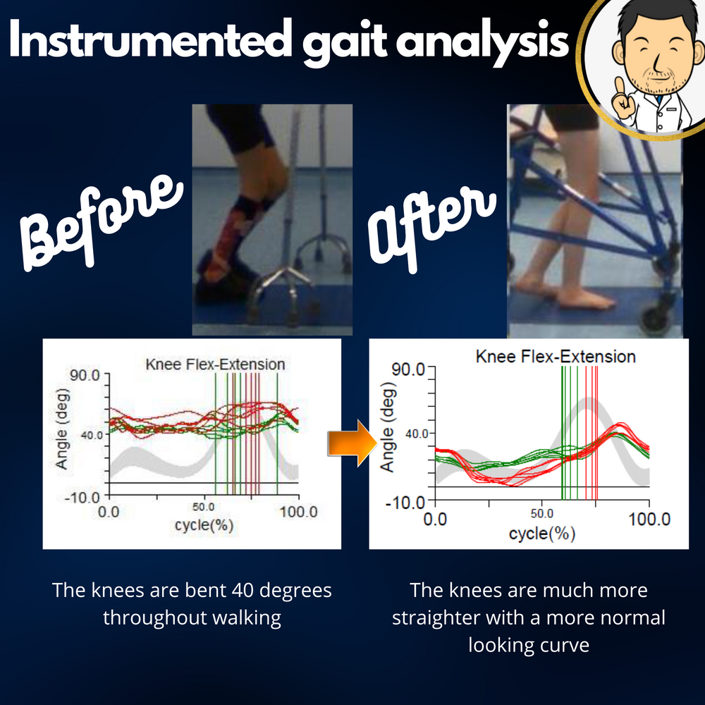 Gait optimisation surgery in Cerebral Palsy