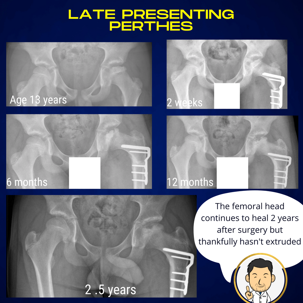 Legg Calve Perthes Disease